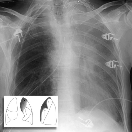 Chest Radiology